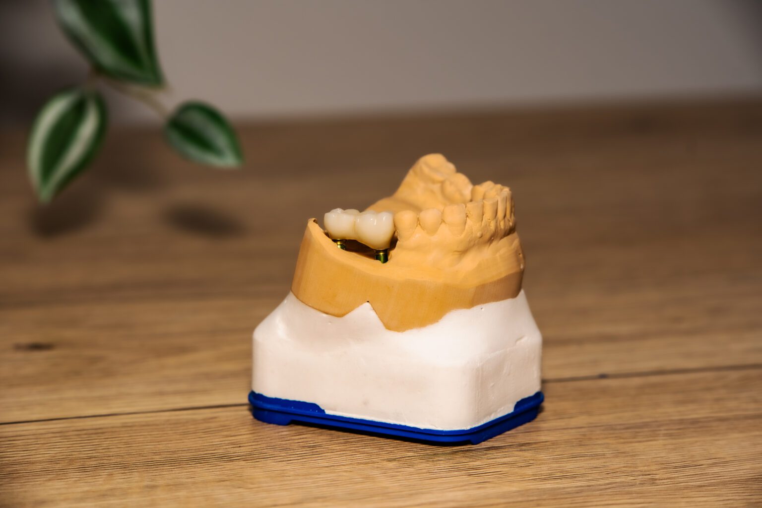 Dental Bridges Preston | Replace Missing Teeth